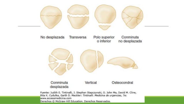 Fractura de rotula