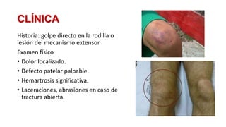 FRACTURA DE ROTULA.pptx