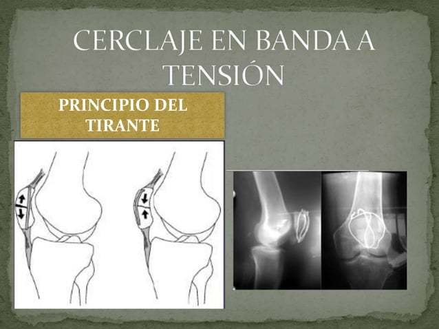 Fractura de rótula hemipatelectomía y patelectomía | PPTX