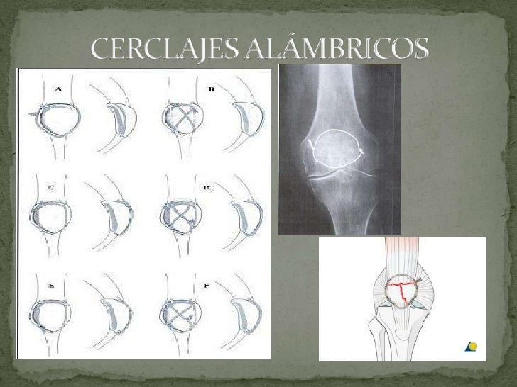 Fractura de rótula hemipatelectomía y patelectomía