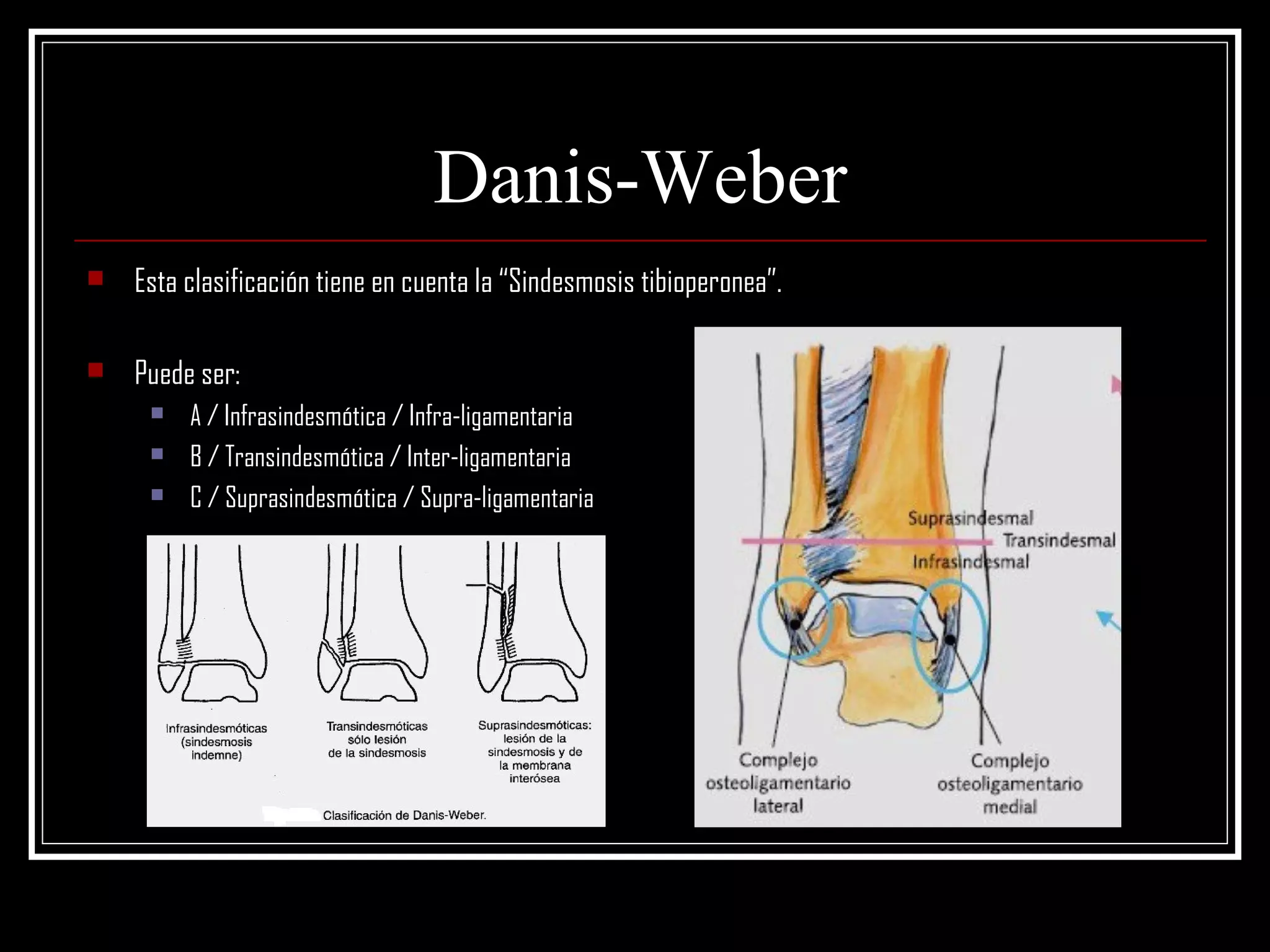 Fracturas de Tobillo | PPT