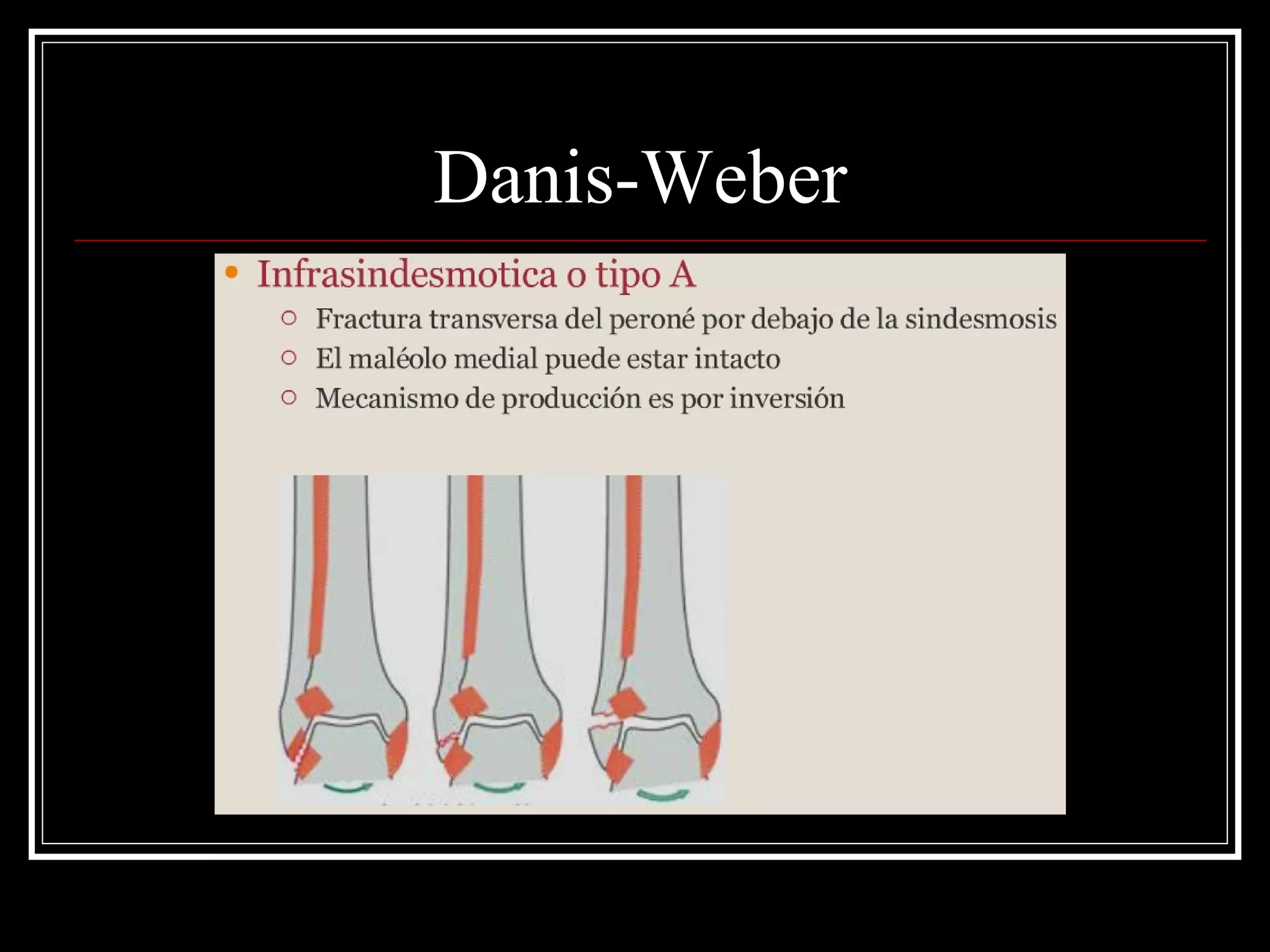 Fracturas de Tobillo | PPT