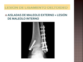 Fractura de tobillo | PPTX