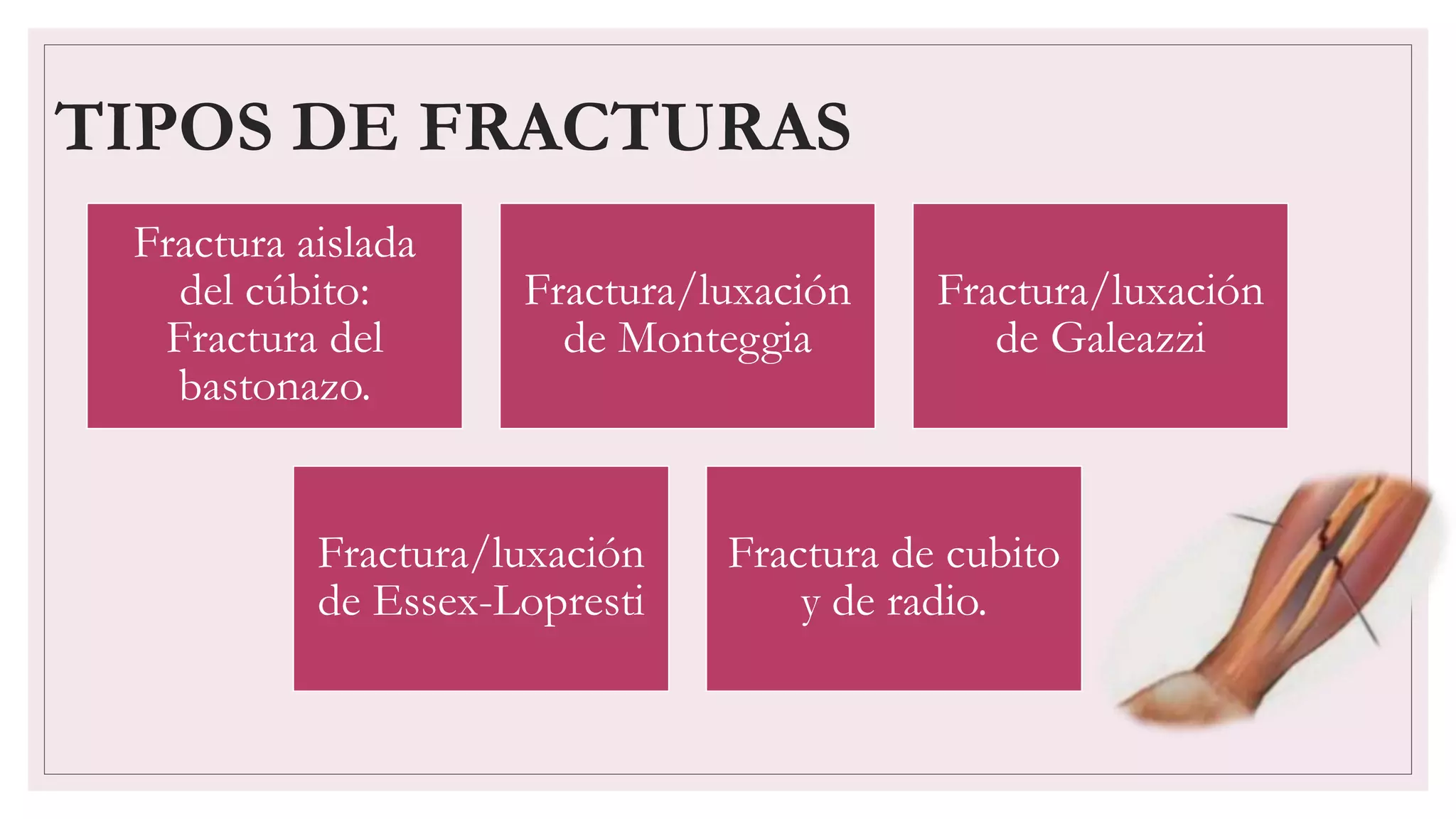 Fractura diafisiaria radiocubital | PPTX