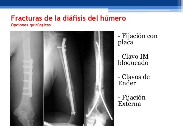 Fractura diafisiarias del humero