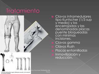 Fractura diáfisis femoral | PPTX