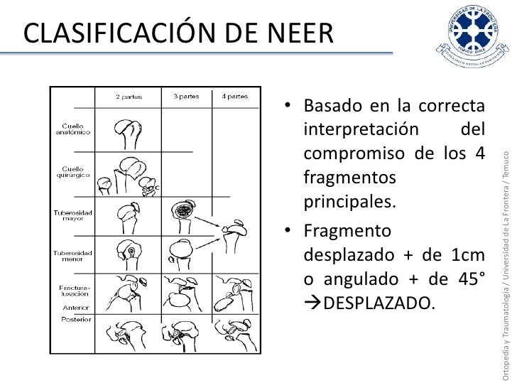 Fractura Humero Codo Antebrazo