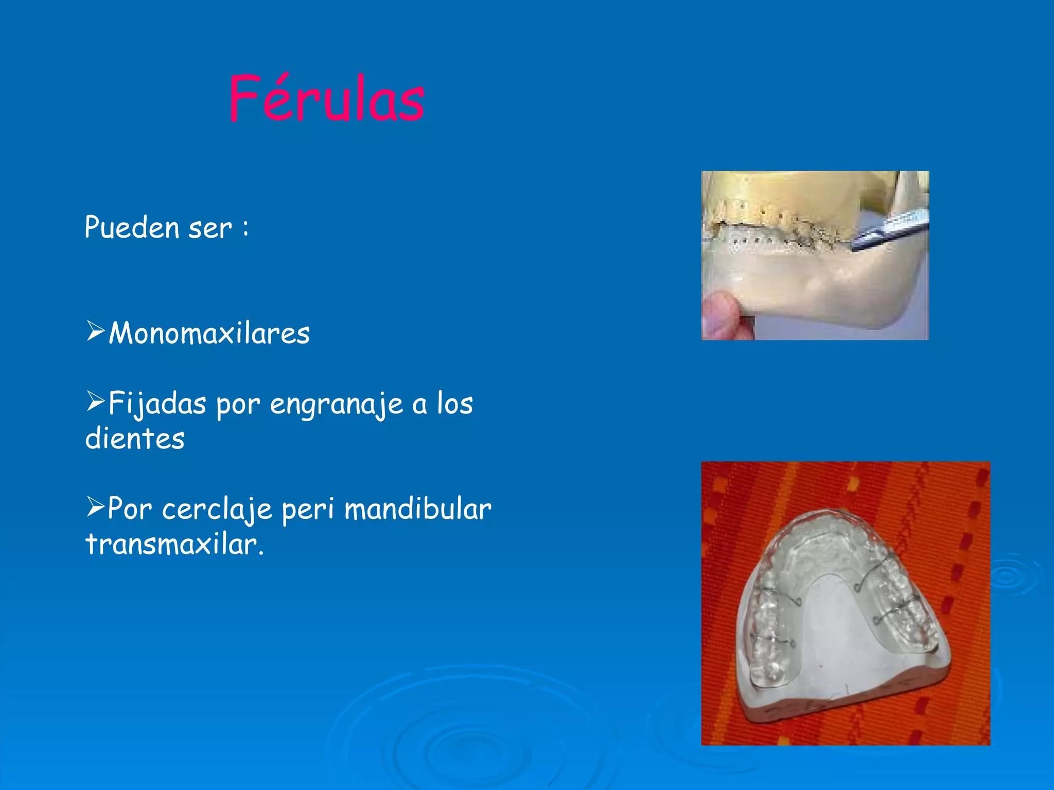 FRACTURA MANDIBULAR | PPT