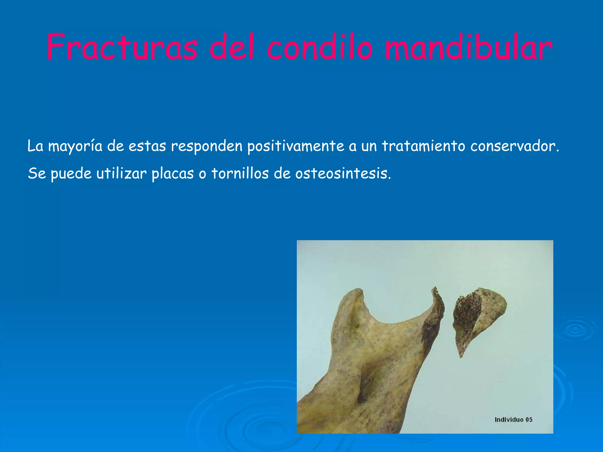 FRACTURA MANDIBULAR | PPT