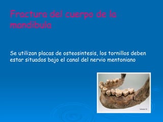 FRACTURA MANDIBULAR | PPT