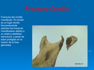 fracturamandibular-091113130504-phpapp01 (1).pptx