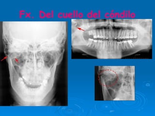 fracturamandibular-091113130504-phpapp01 (1).pptx