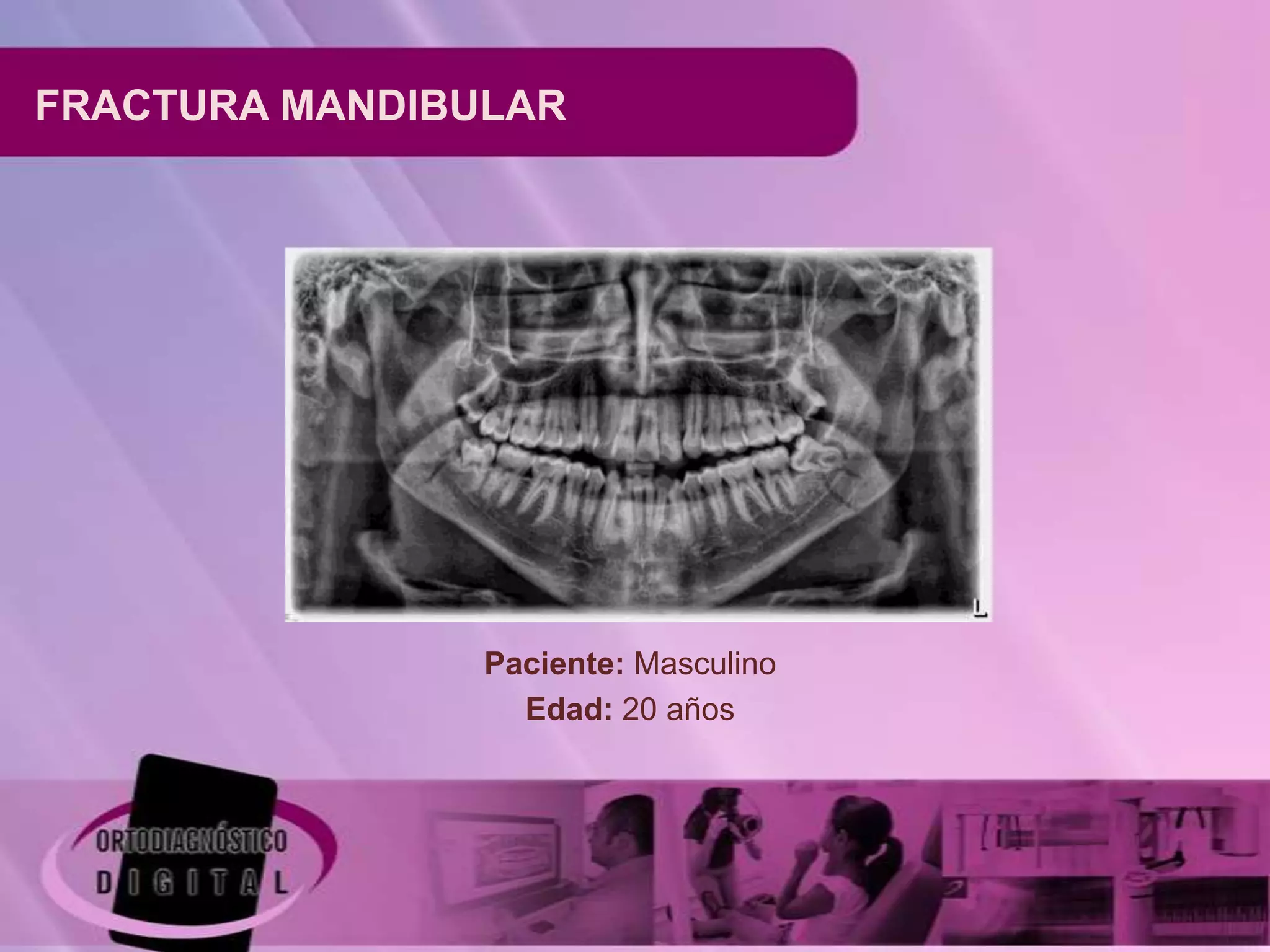 Causas Y Tratamiento De Una Fractura Mandibular – Netzdot