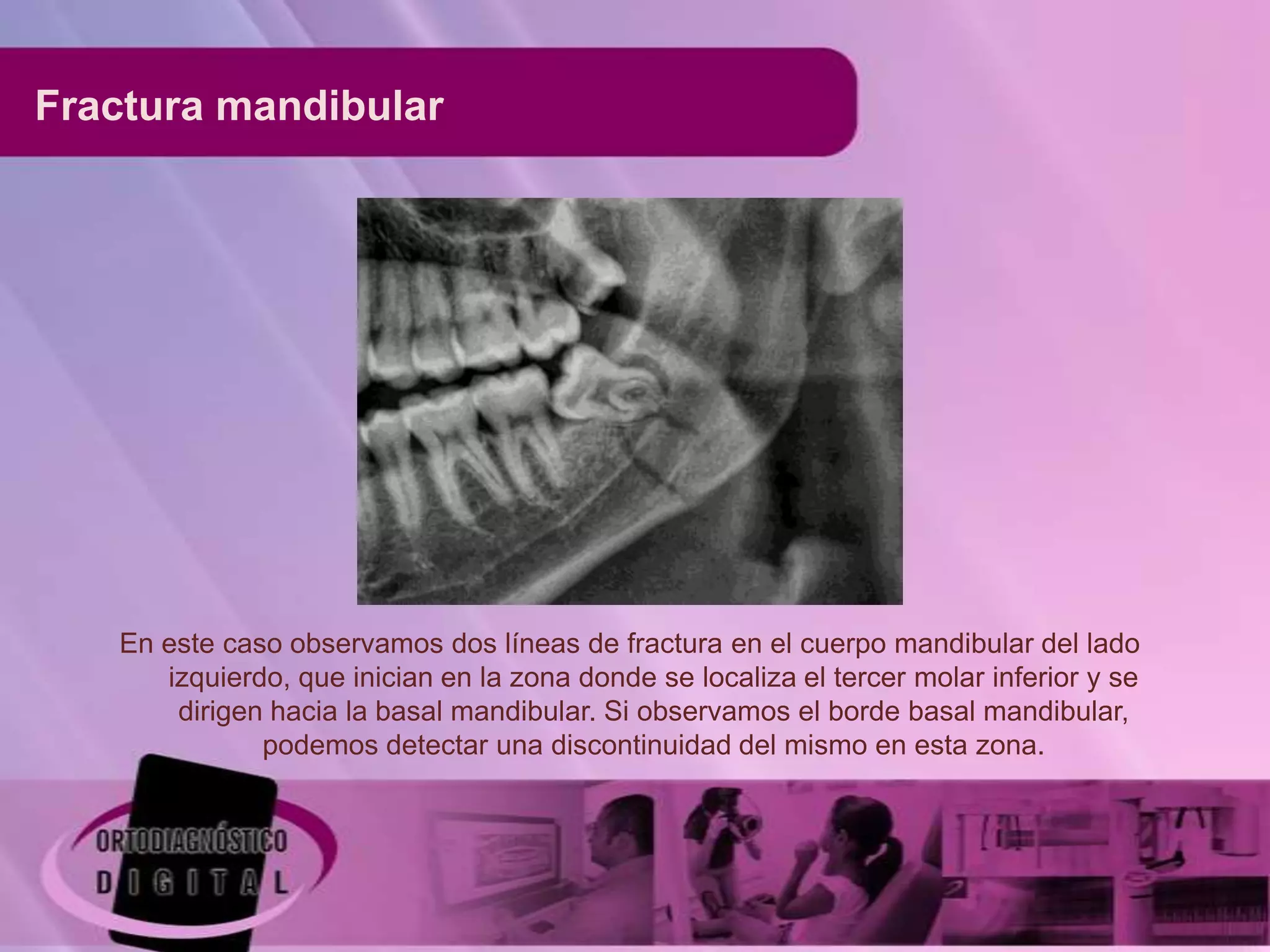Fractura mandibular | PPT