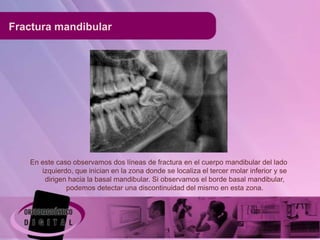 Fractura mandibular | PPTX