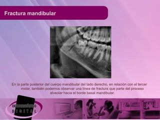 Fractura mandibular | PPTX