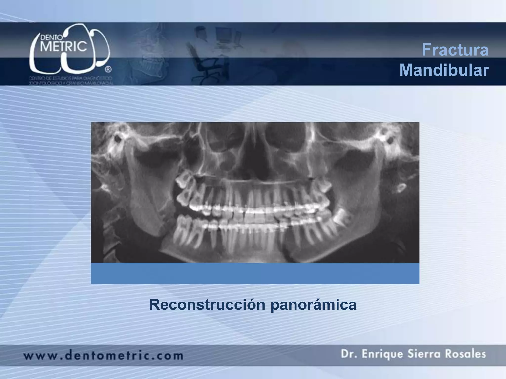 Fractura mandibular | PPT