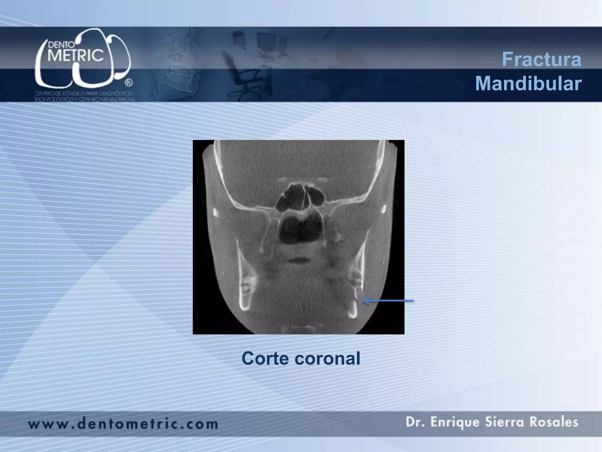 Fractura mandibular | PPT