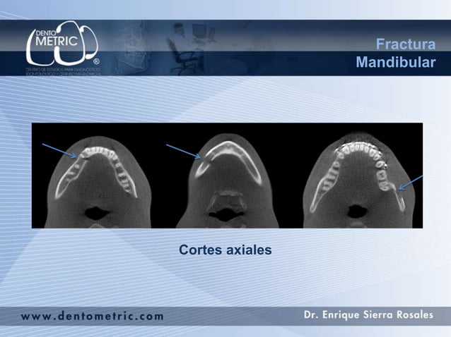 Fractura mandibular | PPT