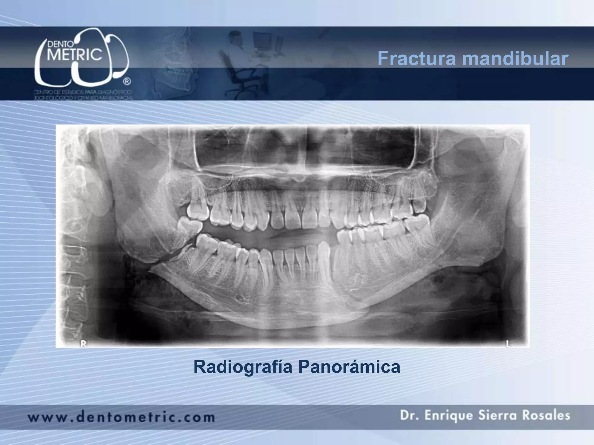 Fractura mandibular | PPT