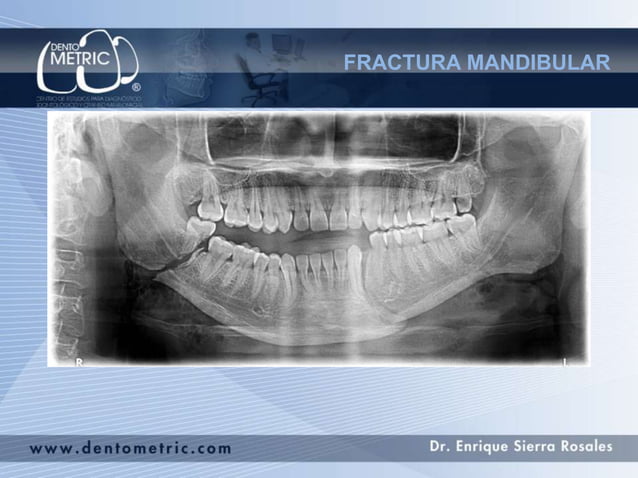 Fractura mandibular | PPT