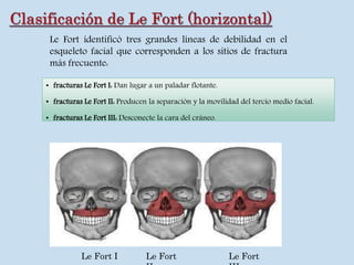 Fractura maxilar | PPTX