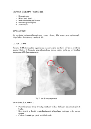Fractura nasal | PDF