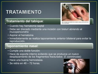 Fractura nasal | PPTX