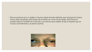 FRACTURA ORBITARIA, ODONTOTOCTOMIAA.pptx