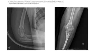 FRACTURA PATOLOGICA SUPRACONDILEA DE HUMERO.pptx