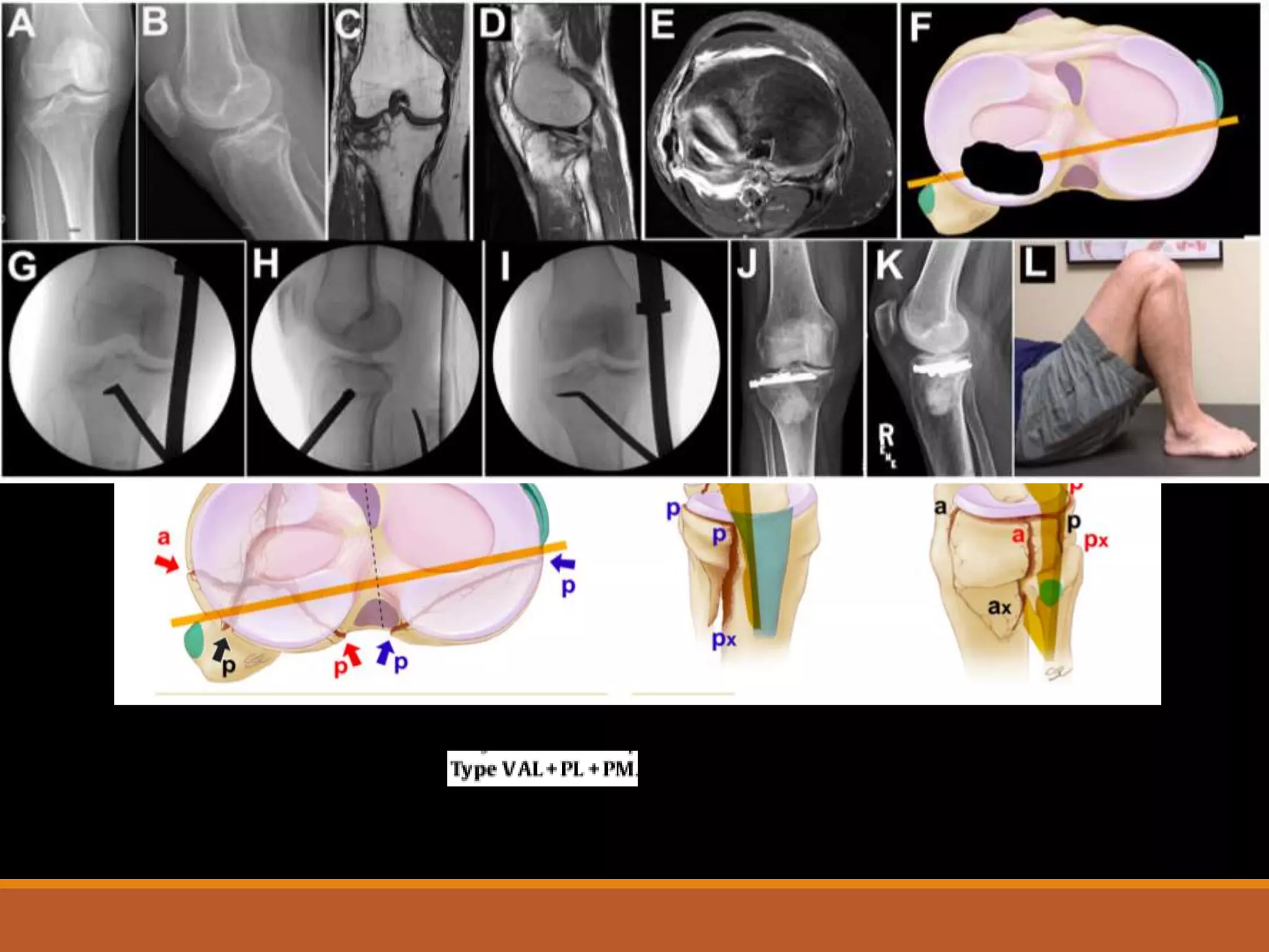 Fractura platillo tibial | PPT