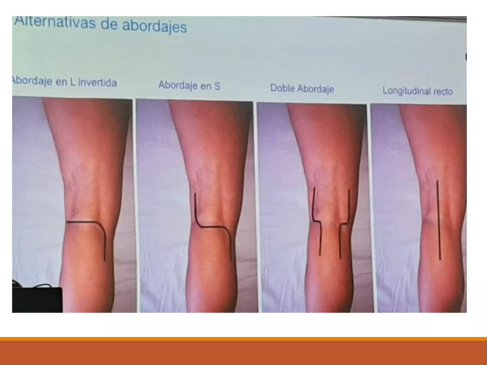 Fractura platillo tibial | PPT