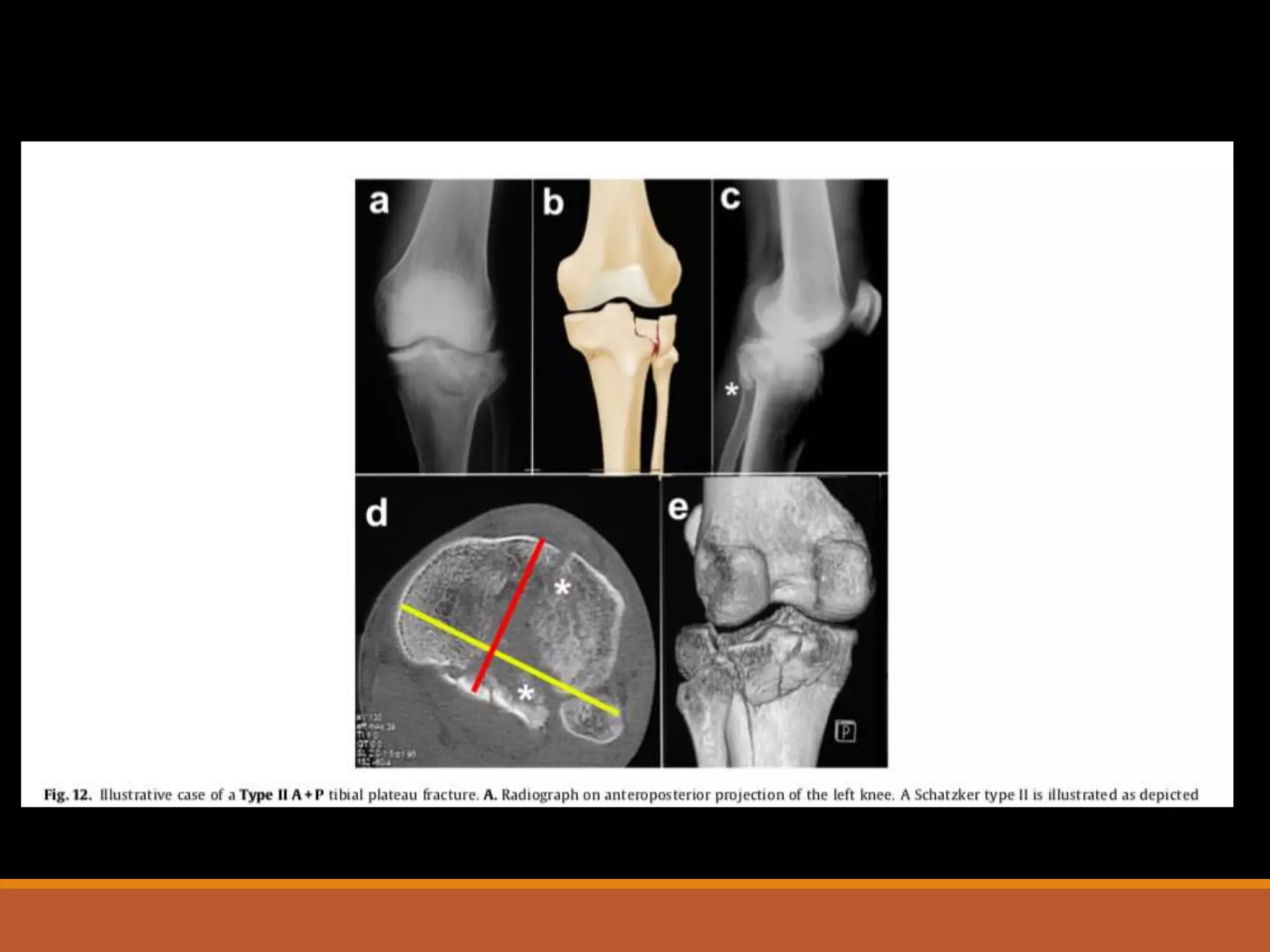 Fractura platillo tibial | PPT