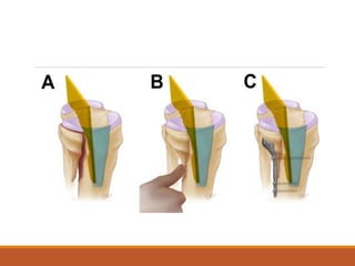 Fractura platillo tibial | PPTX