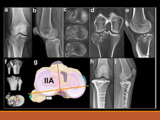 Fractura platillo tibial | PPTX