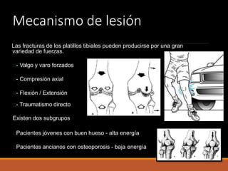Fractura platillo tibial | PPTX