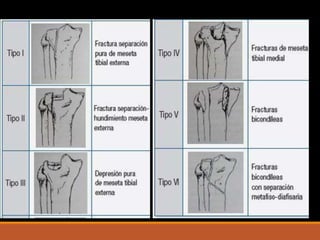 Fractura platillo tibial | PPTX