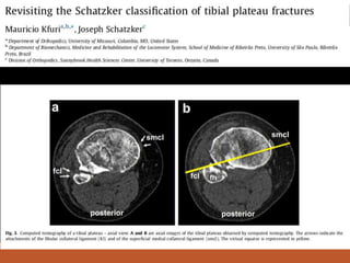 Fractura platillo tibial | PPTX