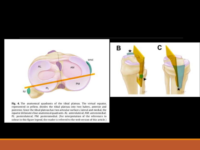 Fractura platillo tibial | PPT