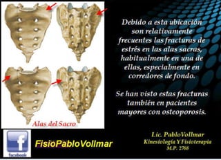 fractura por estres del sacro pablo vollmar.PDF
