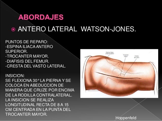 Fractura proximal de femur. vias de abordaje 27.5.15