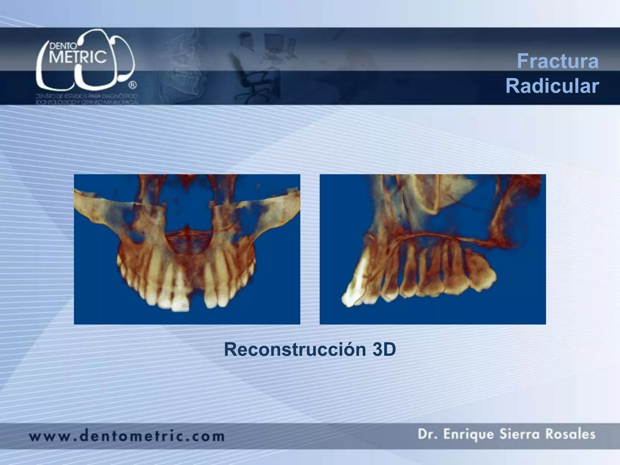 Fractura radicular | PPTX