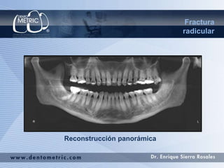 Fractura radicular | PPTX