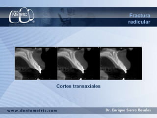 Fractura radicular | PPTX
