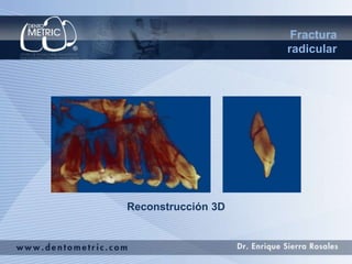Fractura radicular | PPTX
