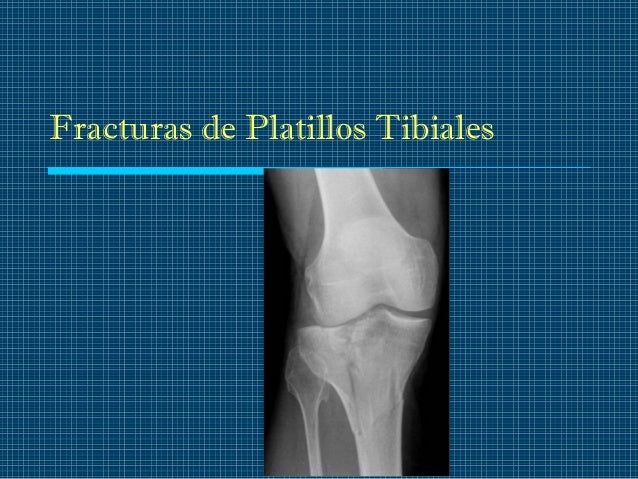 Fractura rotula y fx platillos tibiales