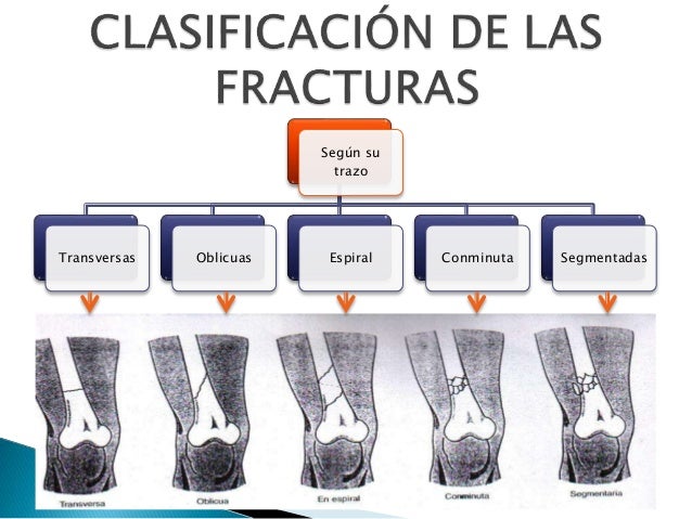 Fracturas