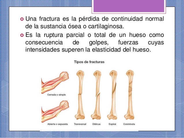 Fracturas Compuestas – Themeroute