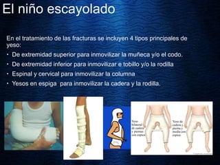 Fracturas | PPTX