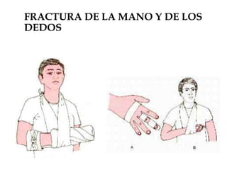 tipos de fracturas y atencion o primeros auxilios | PPT